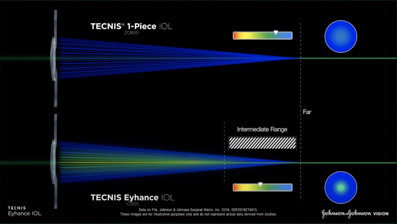 TECNIS Eyhance IOL | サトウ眼科（つくば市） 院長ブログ