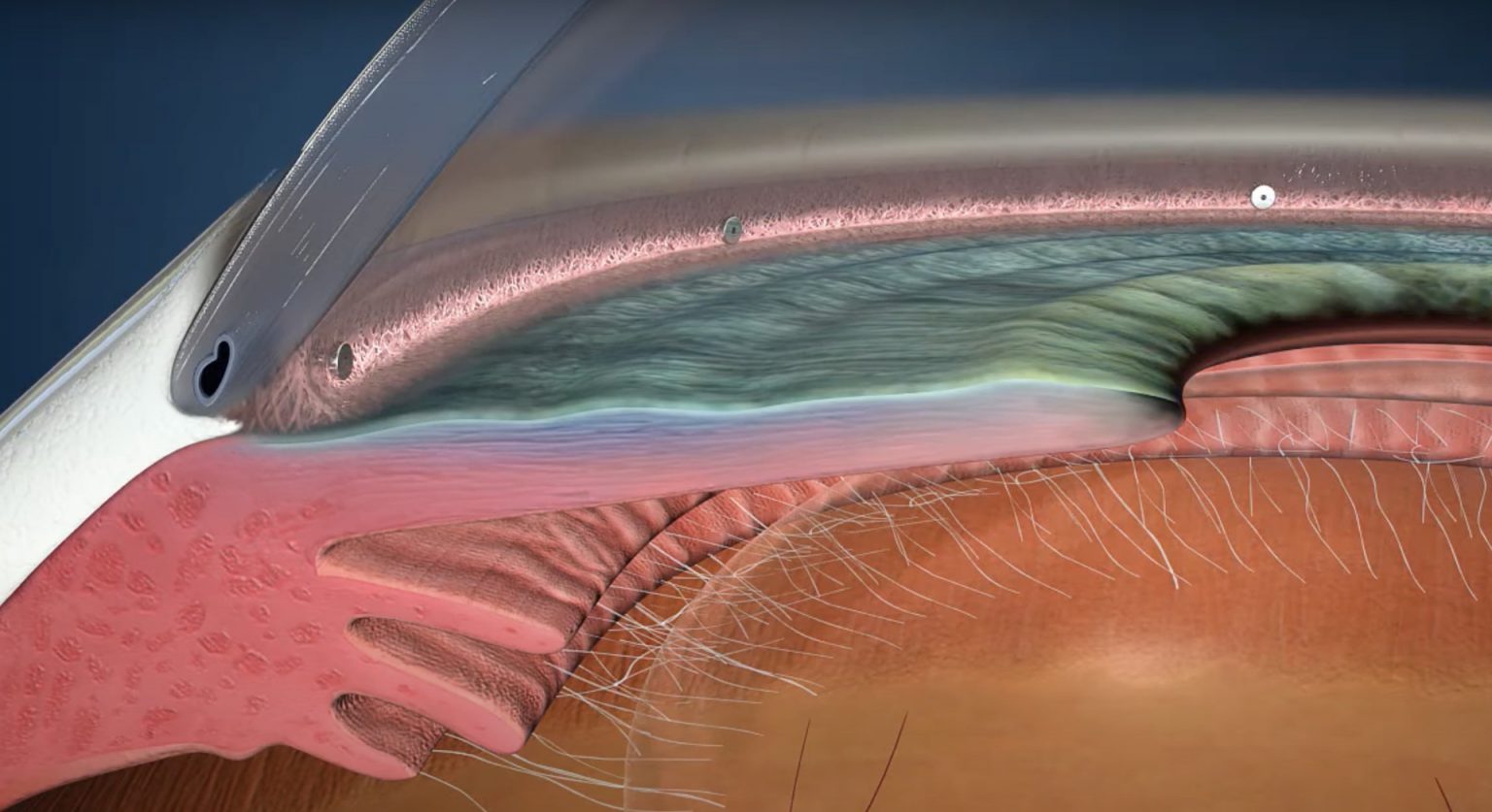 iStent infinite | サトウ眼科（つくば市） 院長ブログ